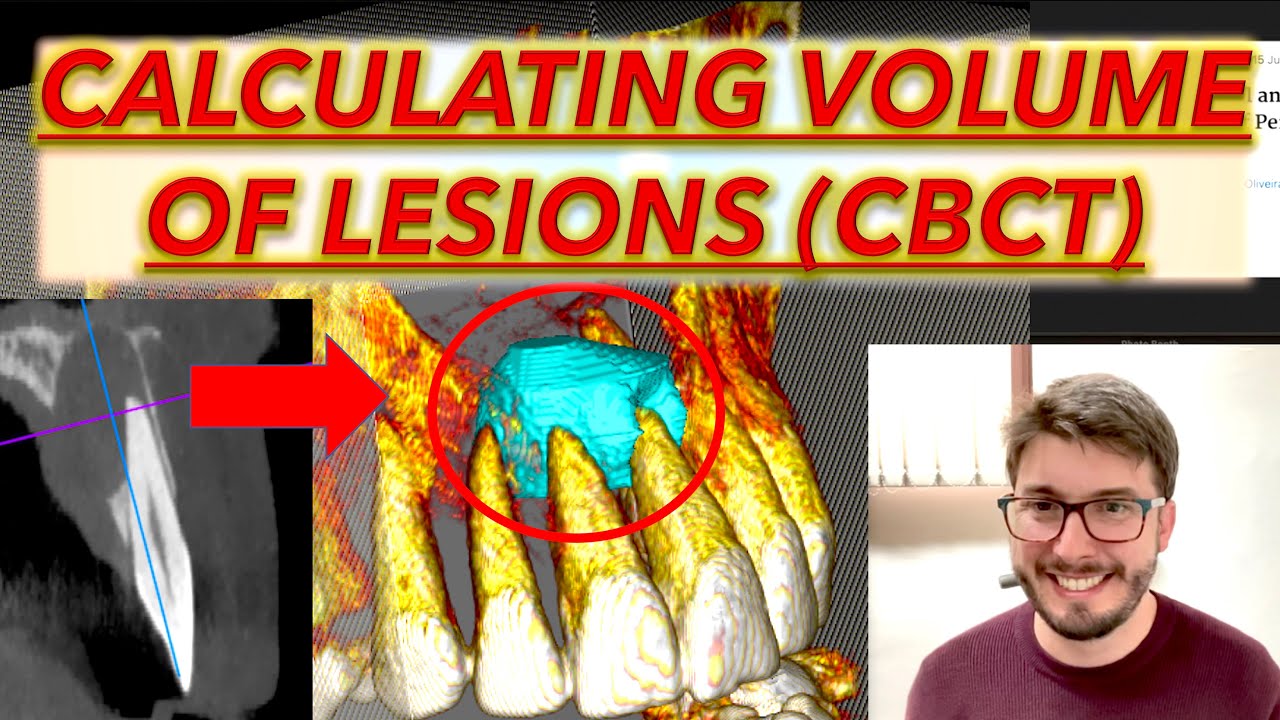 How to Calculate Volume of Periapical Lesions on CBCT (and of anything ...