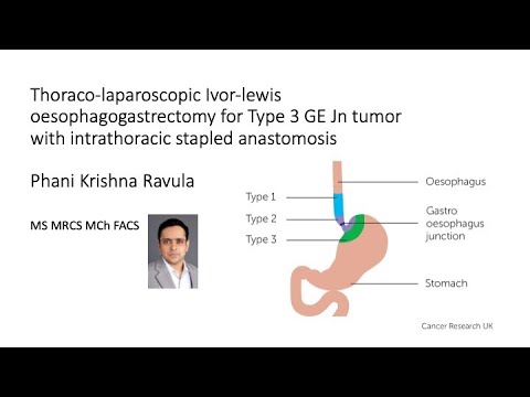 Thoraco-laparoscopic ivorlewis oesophagogastrectomy for Type 3 GE Jn ...