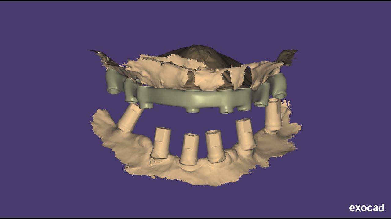 Upper & lower titanium bar designing for simpladent basal implant in ...