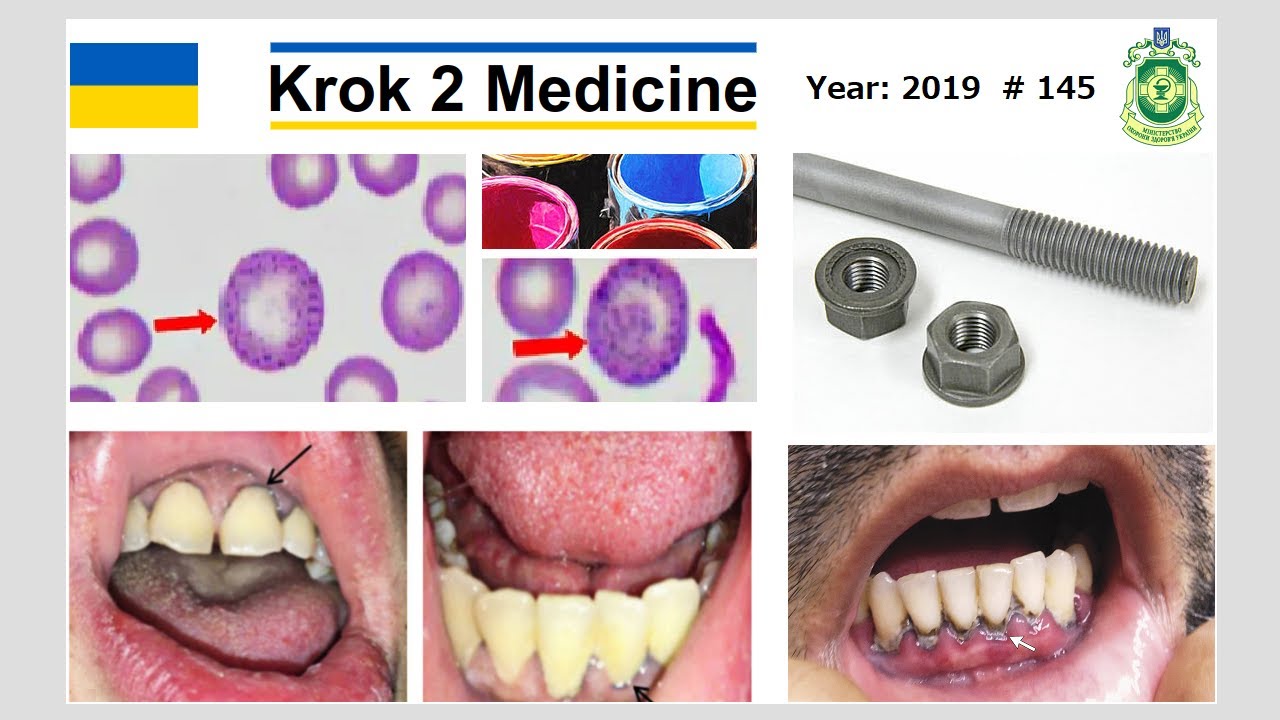 [ Krok 2 Medicine ] Year: 2019 - 145 (Ministry of Public Health of ...