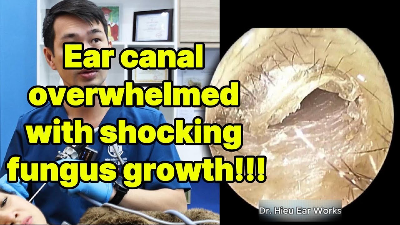 Ear canal overwhelmed with shocking fungus growth | ear cleaning | ASMR ...