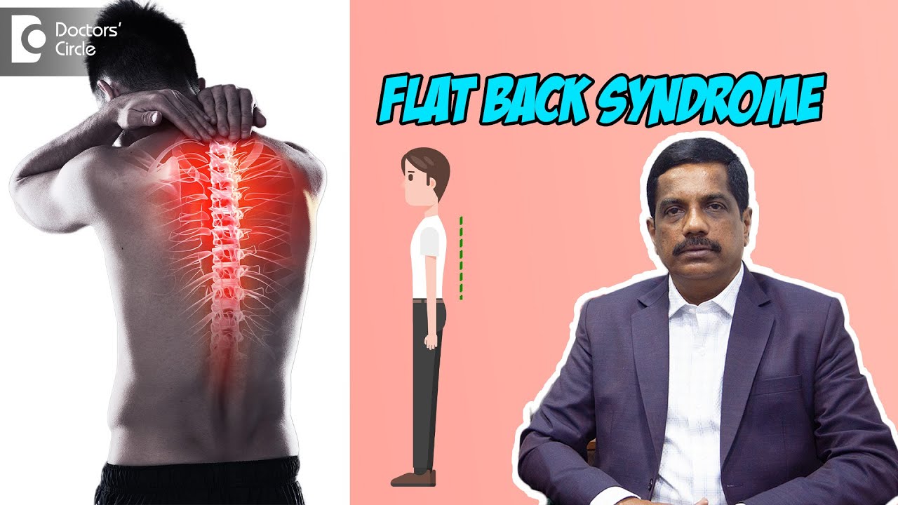 Flat Back Syndrome| Straightening of Spine| Back Pain - Dr Kodlady ...