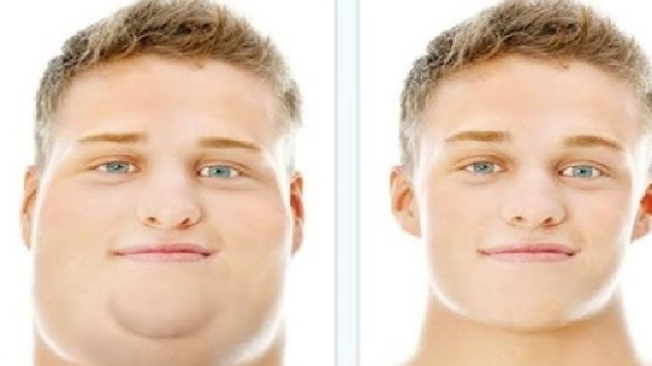 how to get rid of chubby cheeks when smiling easy - YouTube