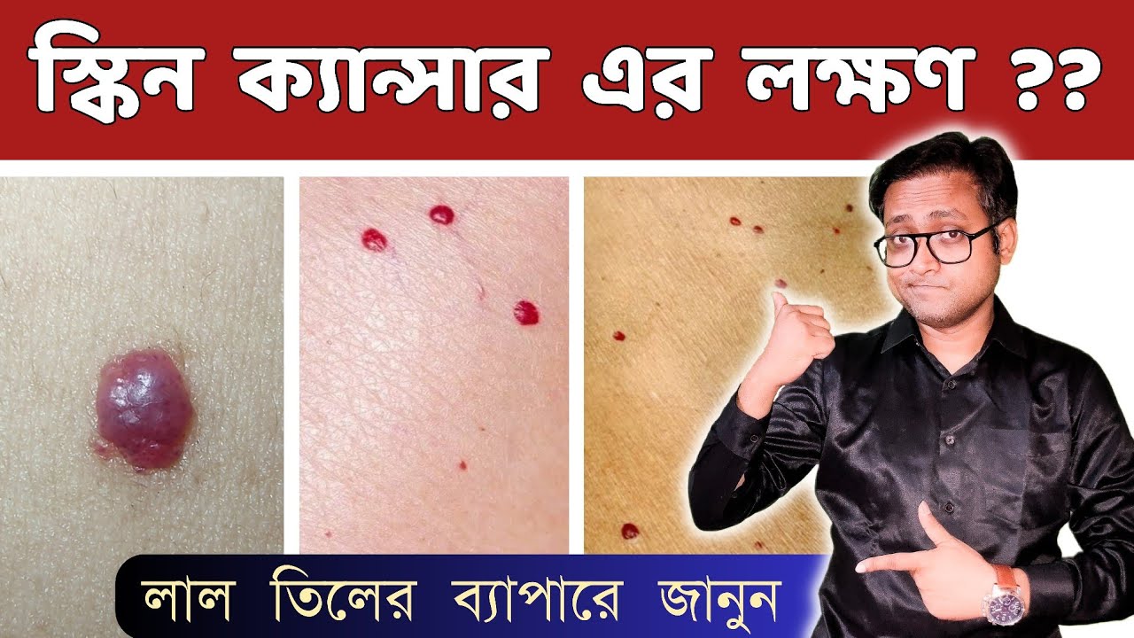 লাল তিল কেন হয় ? Cherry angioma | Senile angioma - cause & treatment ...