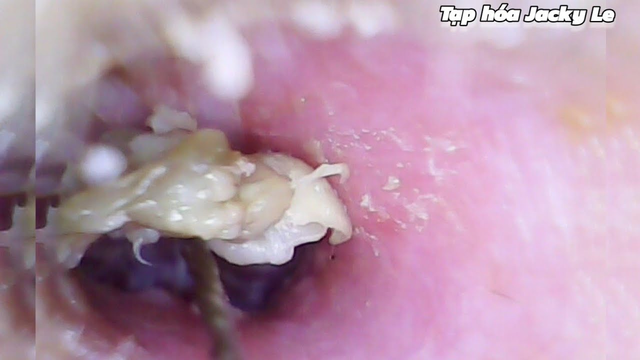 Ear Wax Removal #161: Ear fungus and itching. Earwax is wet and smells ...