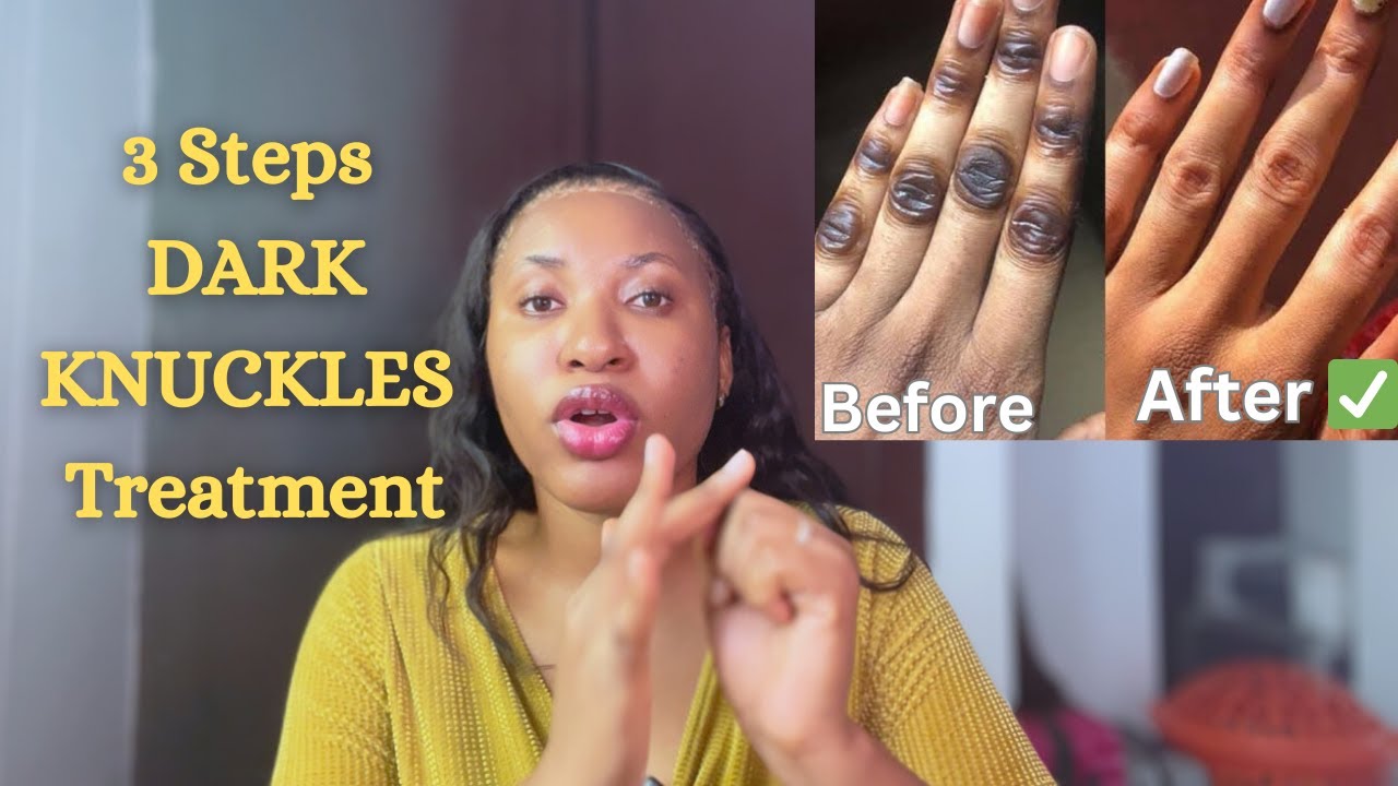 HOW TO EFFECTIVELY GET RID OF DARK KNUCKLES | causes & treatment - YouTube