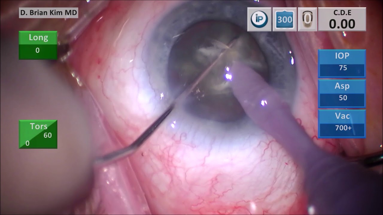 The Best Way to Do Cataract Surgery #1: Mechanical Fracturing the 2-3 ...