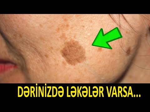 Bədəninizdə ləkələr var? - Səbəbi BU ola bilər