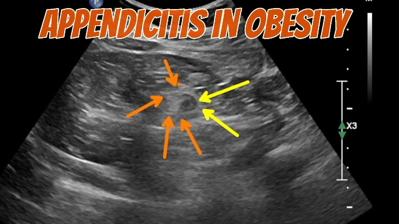 [Ultrasound Case] Live Demonstration – Acute Appendicitis in Large Body Habitus - YouTube