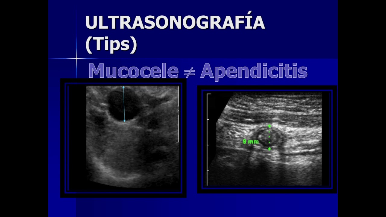 Mucocele Apendicular. A propósito de dos casos. Dra María Yaqueline ...