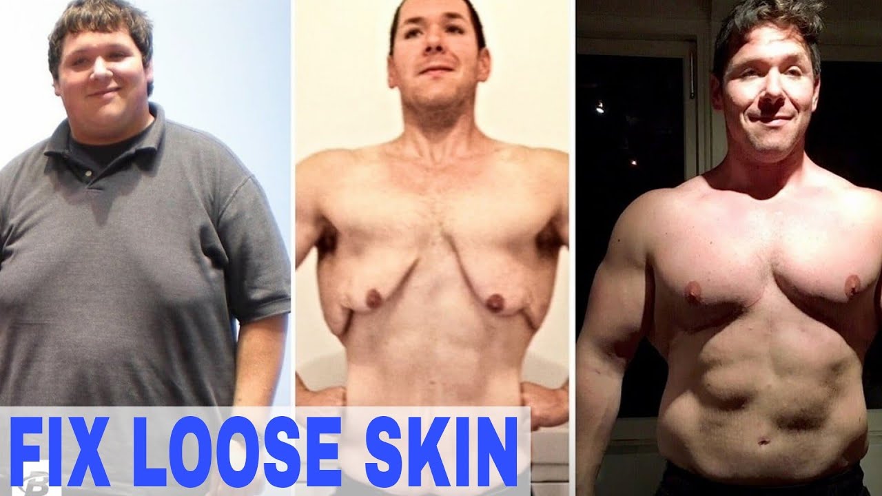 How To Fix Loose skin after weight loss men without surgery | BT ...