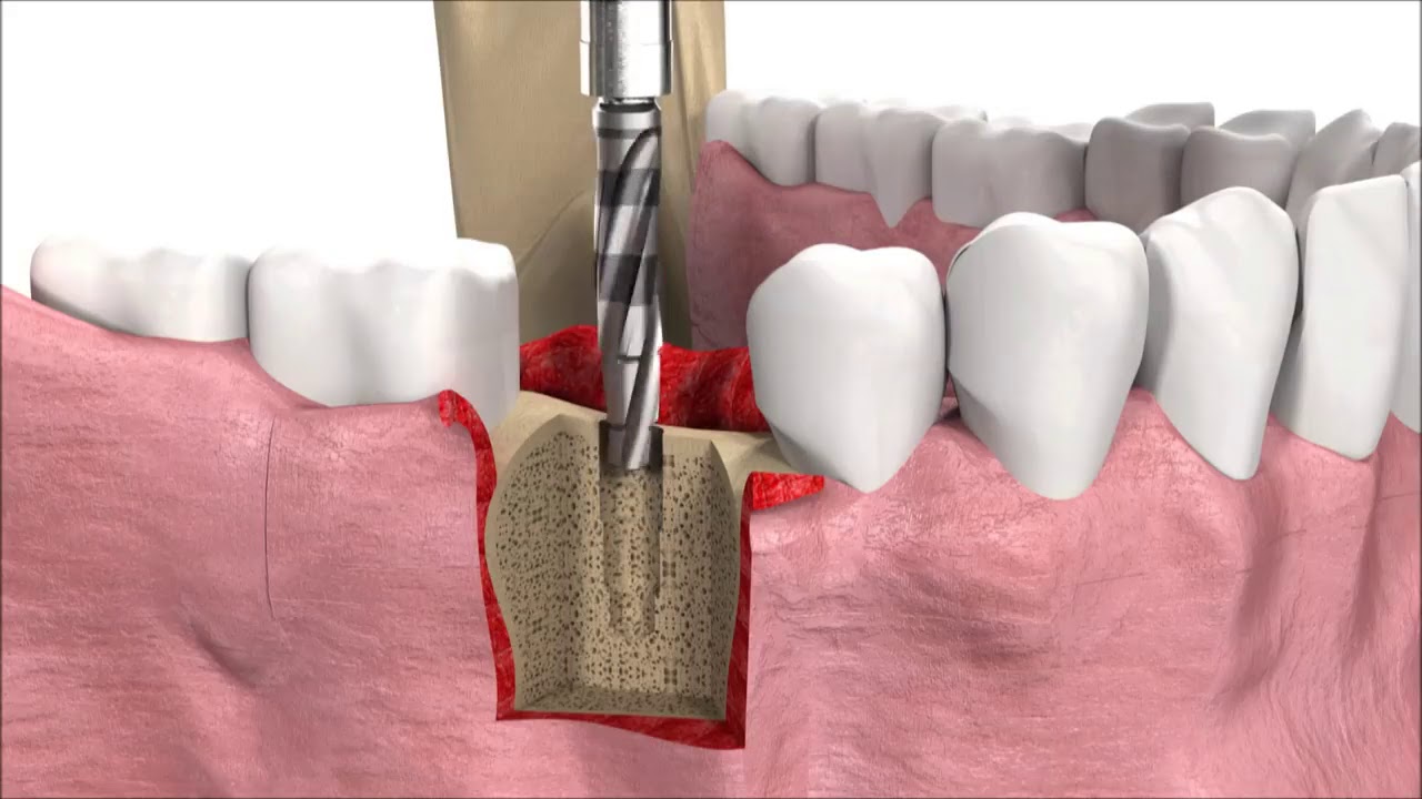 SIC invent Dental Implant Procedure SICmax implant insertion - YouTube