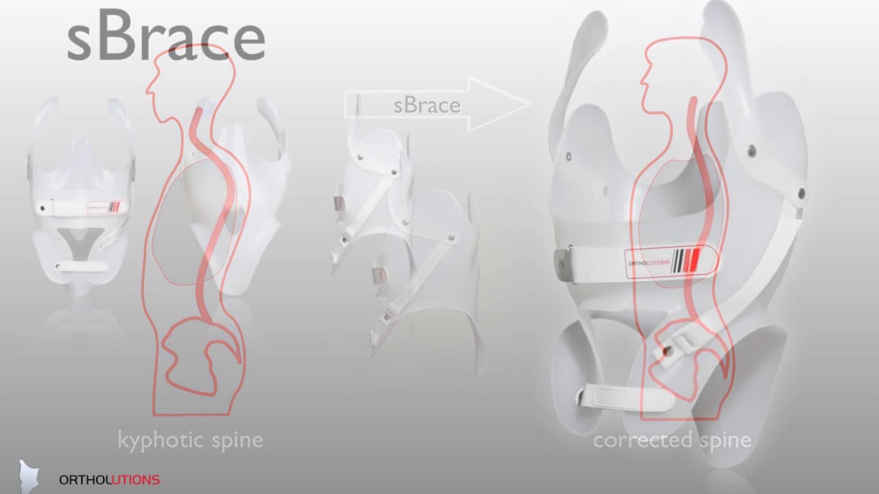Kyphose Korsett sBrace - Hyperextension back brace sagittal realignment ...