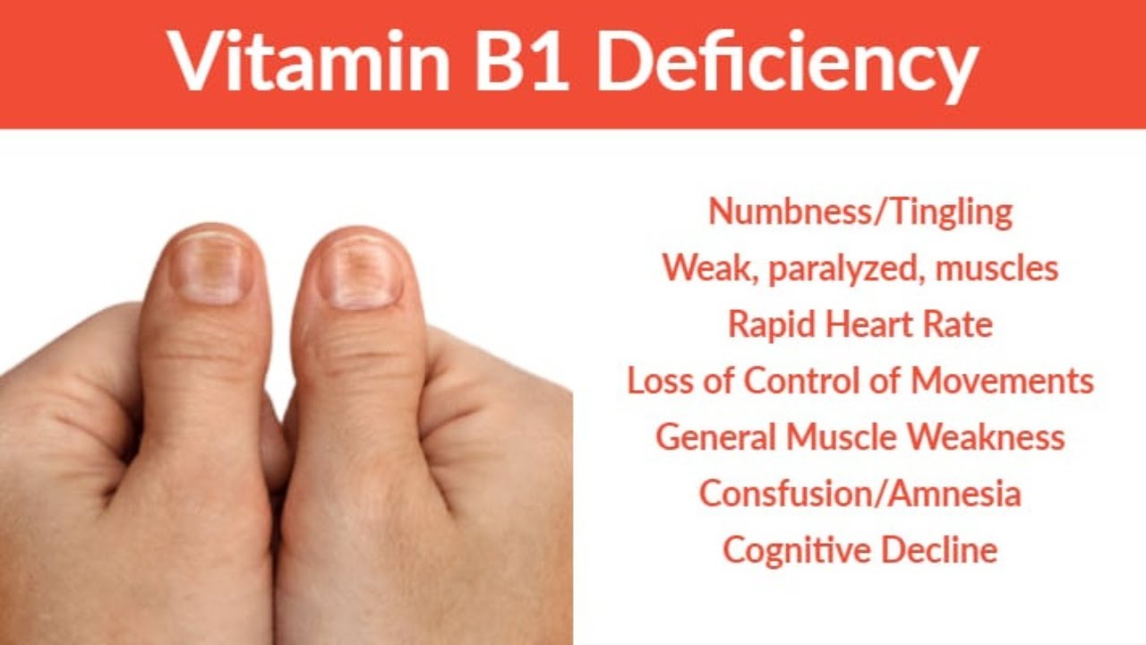 Thiamine Vit B1| Thiamine (Vit B1)Deficiency | Signs , Symptoms ...