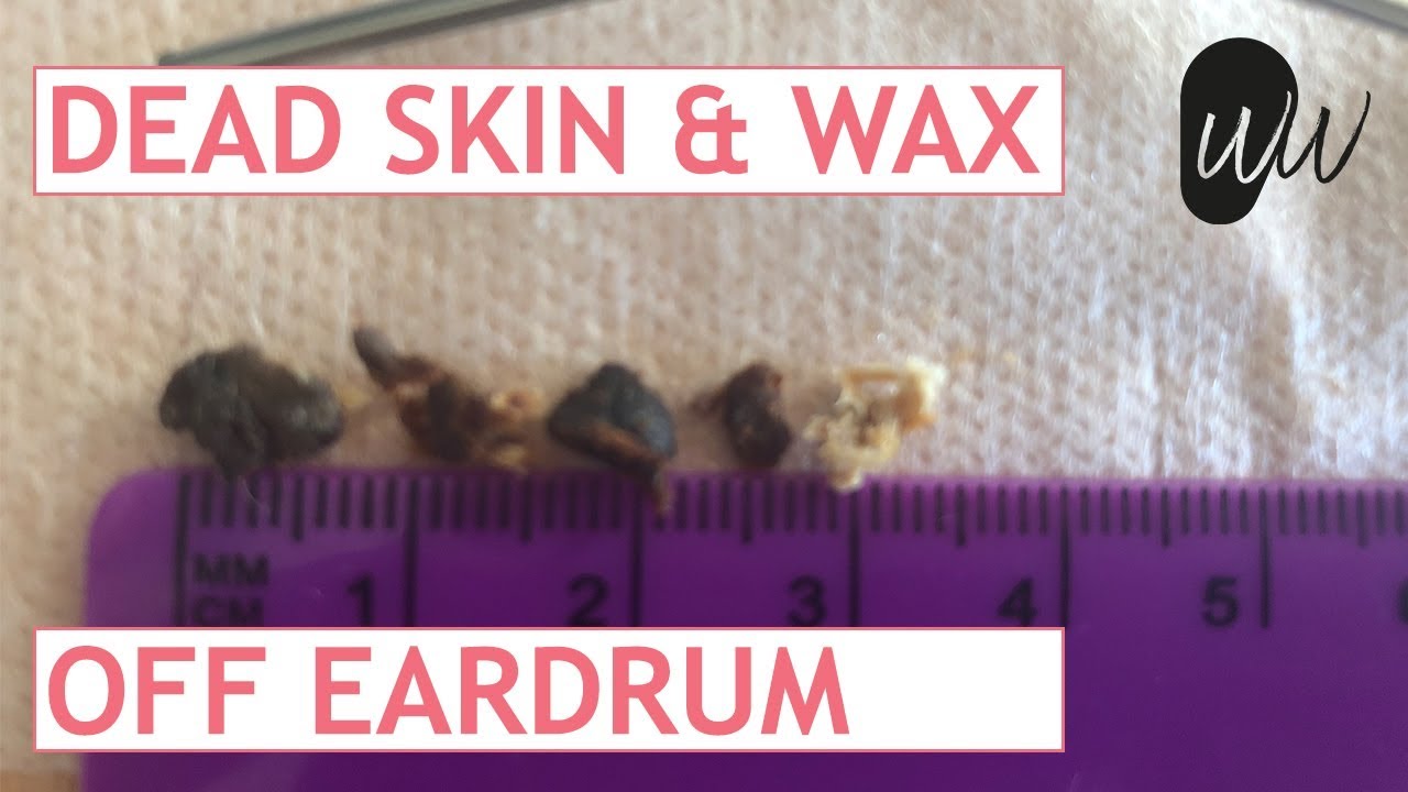 Hard Ear Wax & Dead Skin Removal off Eardrum - #363 - YouTube