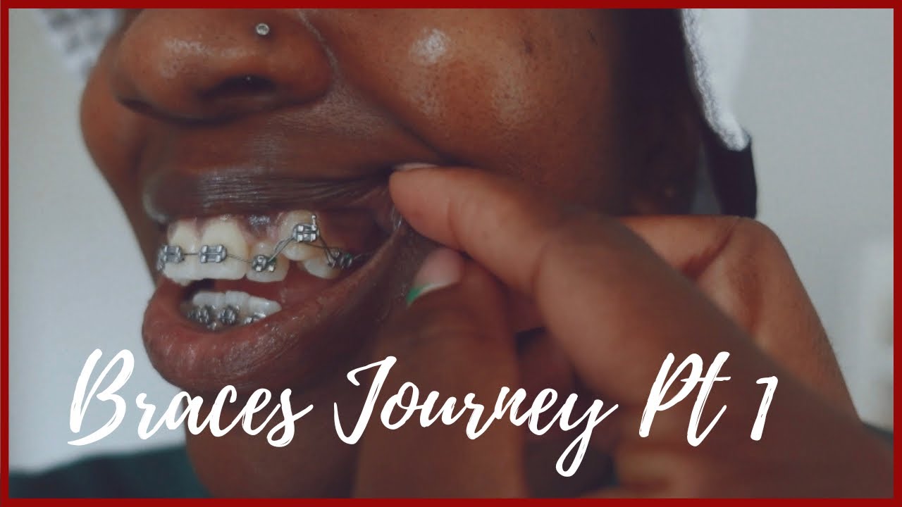 ADULT BRACES JOURNEY | CONSULTING, TOOTH EXTRACTION & FITTING PROCESS ...