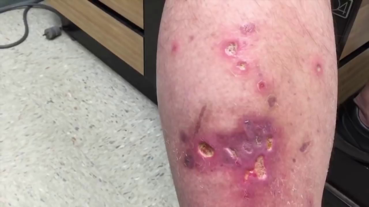 Mrsa Rash On Legs