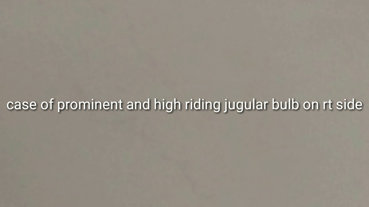Case of High riding jugular bulb rt side - YouTube