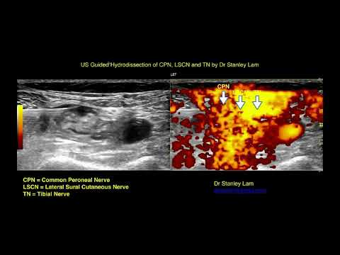 Ultrasound-guided nerve hydrodissection for pain management ...