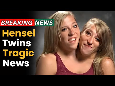 Doctors Share Sad News of Hensel Twins’ Surgery - YouTube