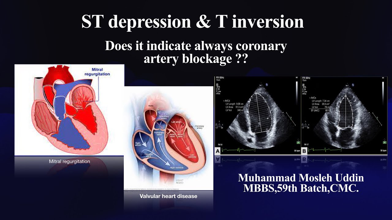 ST depression and T inversion মানেই কি coronary artery তে block আছে ...