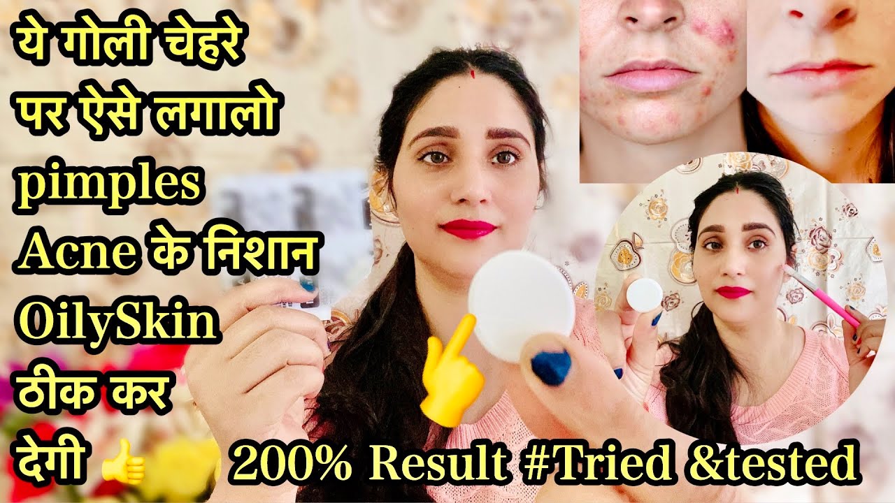 1day Challenge-use this tablet Remove Pimples,Acne,oilySkin,pimpleMarks ...