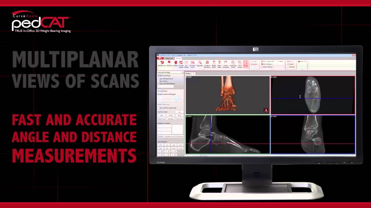 Curve Beam PedCat Overview - YouTube