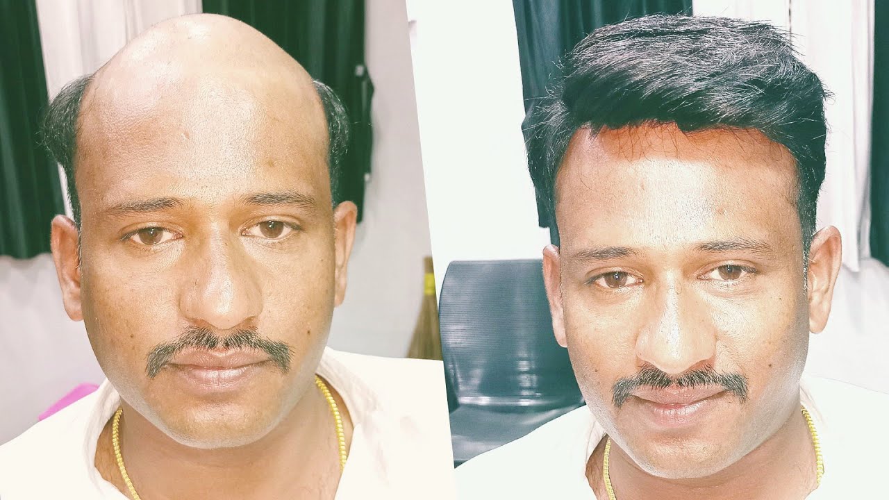 Hair fall | Hair loss | Hair Patch in patna | Hair wig in patna ...