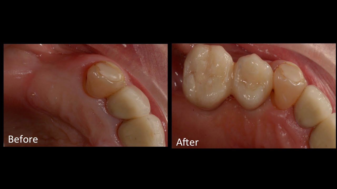 Dental Implant for upper right premolars - YouTube