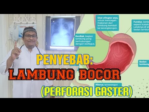 PENYEBAB LAMBUNG BOCOR ATAU PERFORASI GASTER - YouTube