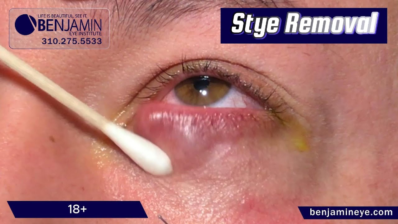 A quick and effective Stye removal procedure - YouTube