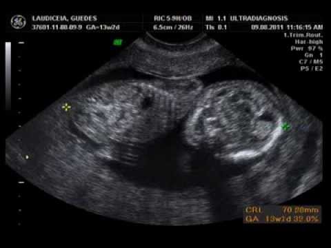 Gestação de 3 meses do bebê Ana Esther - YouTube