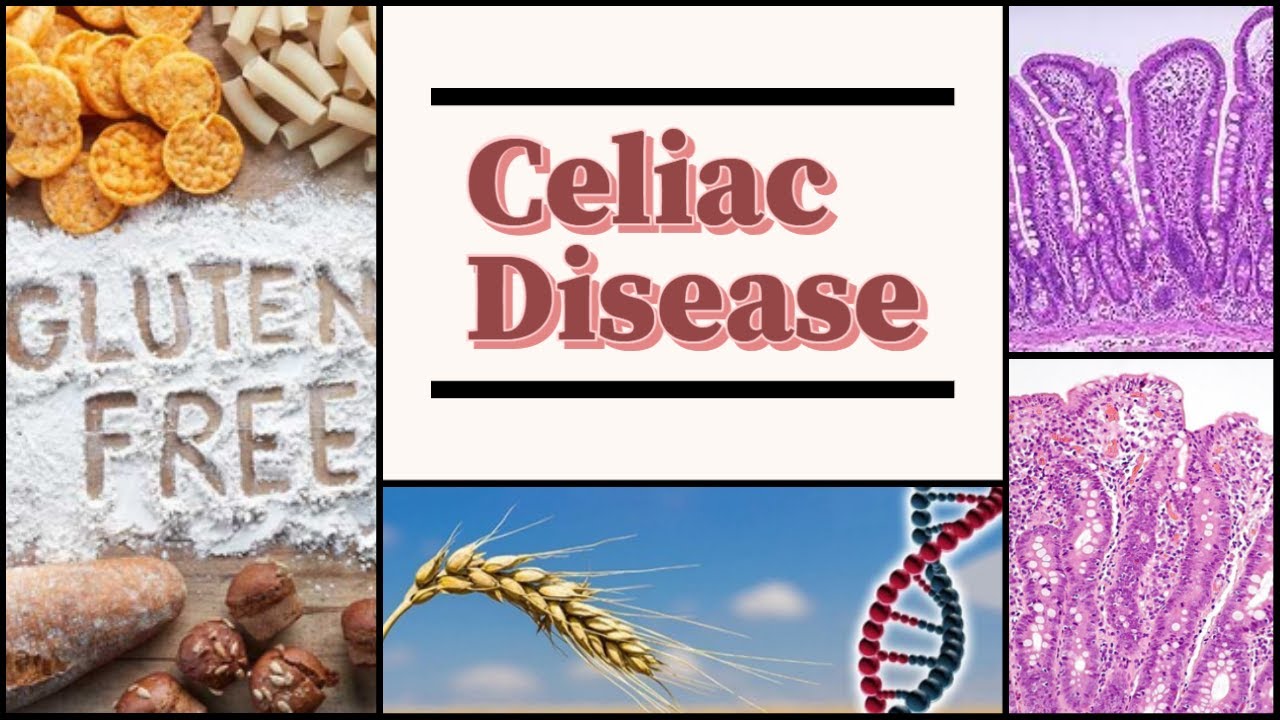 Celiac Disease |Enteropathy |Autoimmune condition |Food sensitivity ...