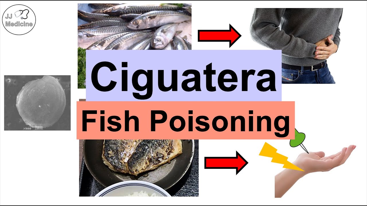 Ciguatera Fish Poisoning (Ciguatoxin) | Symptoms (Numb Feet, Diarrhea ...