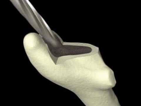 Revelation Lateral Flare Surgical Animation - YouTube