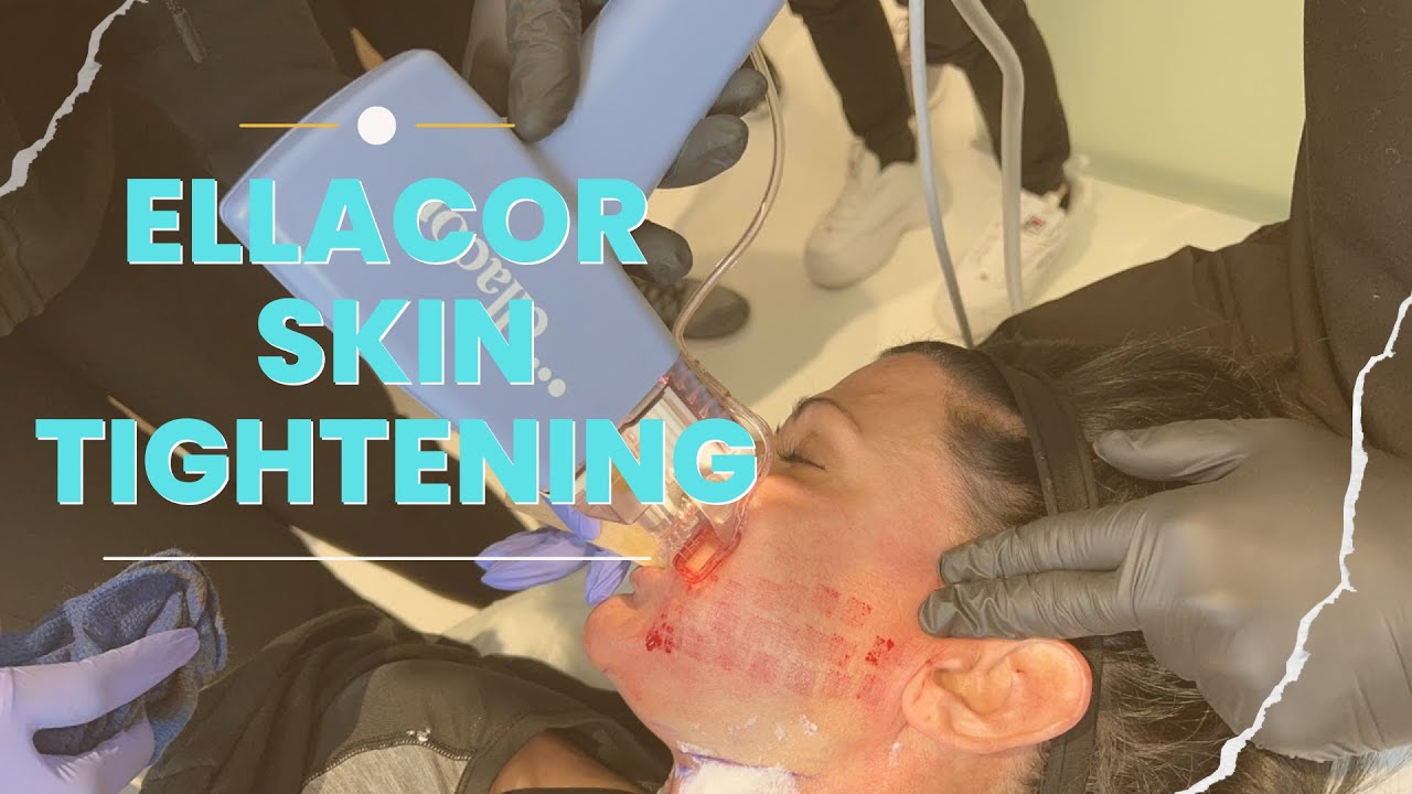 NEW ELLACOR NON SURGICAL SKIN TIGHTENING WHILE AWAKE | Dr. Jason Emer ...