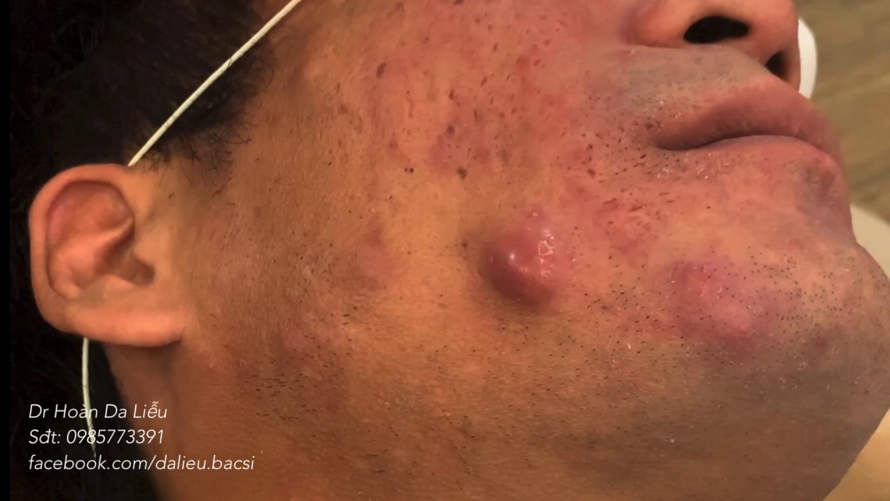 Very big Acne on the face | Mụn nhọt khổng lồ trê mặt toàn mủ - YouTube