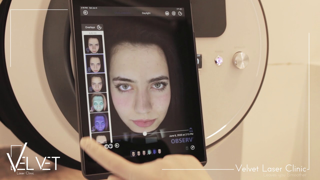 velvet laser clinic skin analyzing - YouTube