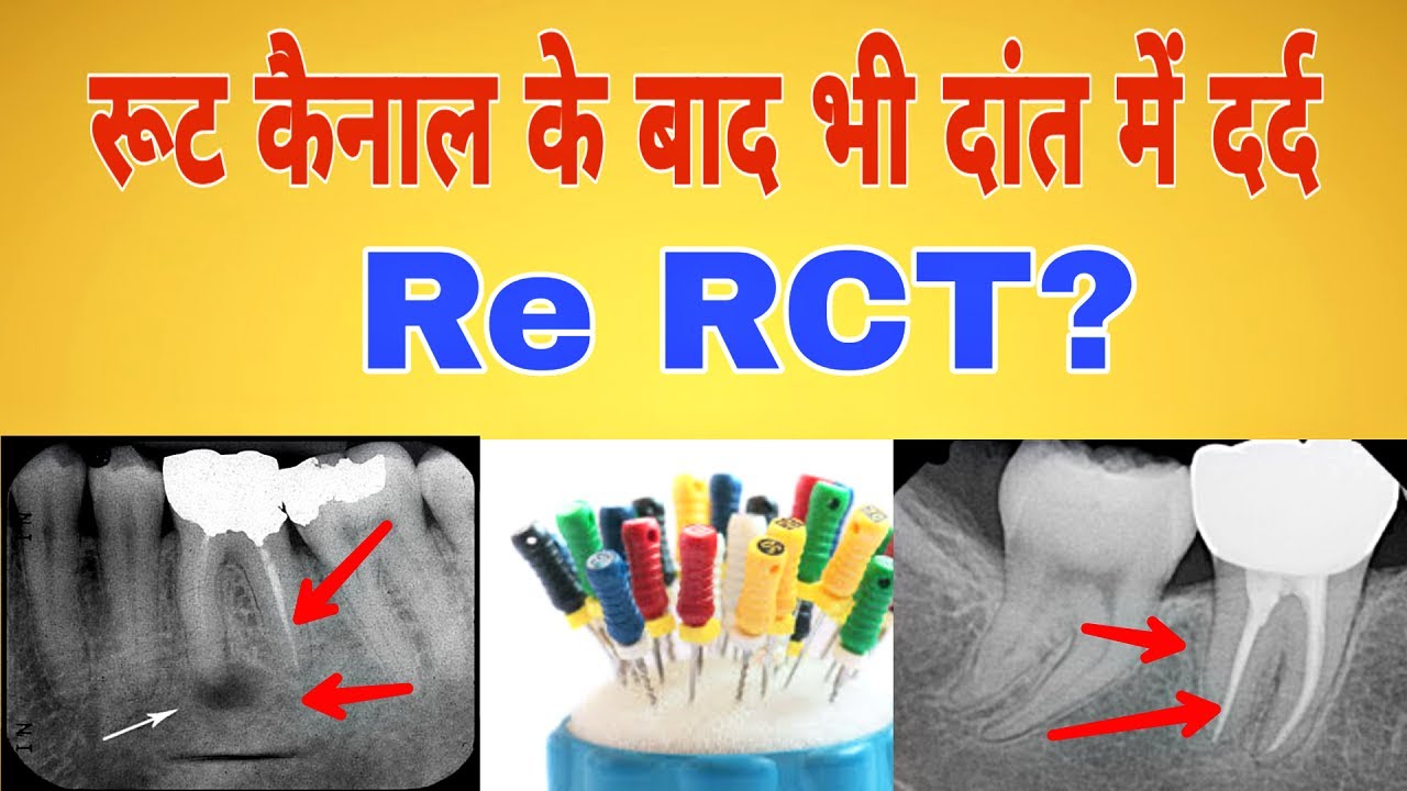 What is Re Rct? Re Root Canal Treatment Kya Hota Hai | क्यों करते है Re ...