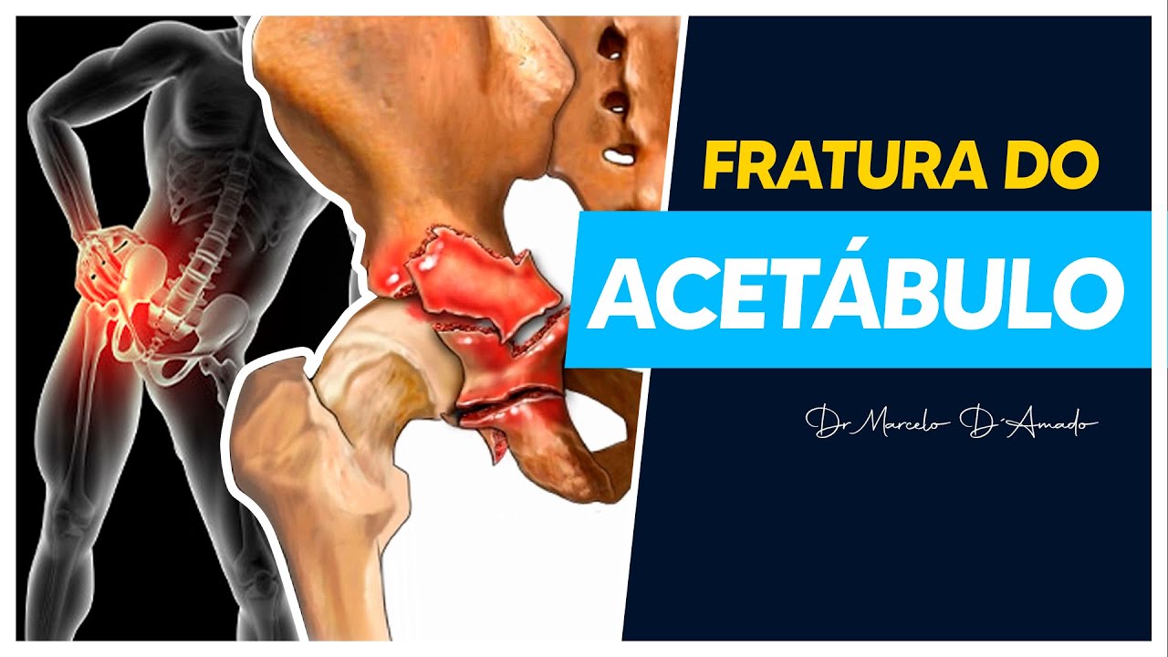 TUDO O QUE VOCÊ PRECISA SABER SOBRE FRATURA DO ACETÁBULO | TRATAMENTO E ...