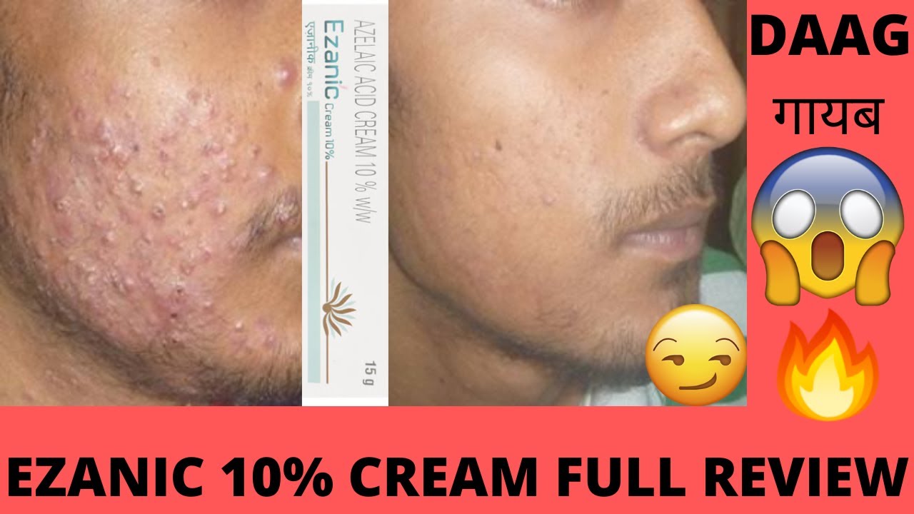 Ezanic 10% Cream Full Review ! Say Goodbye to Acne WoesAcne Ki Adiyein ...