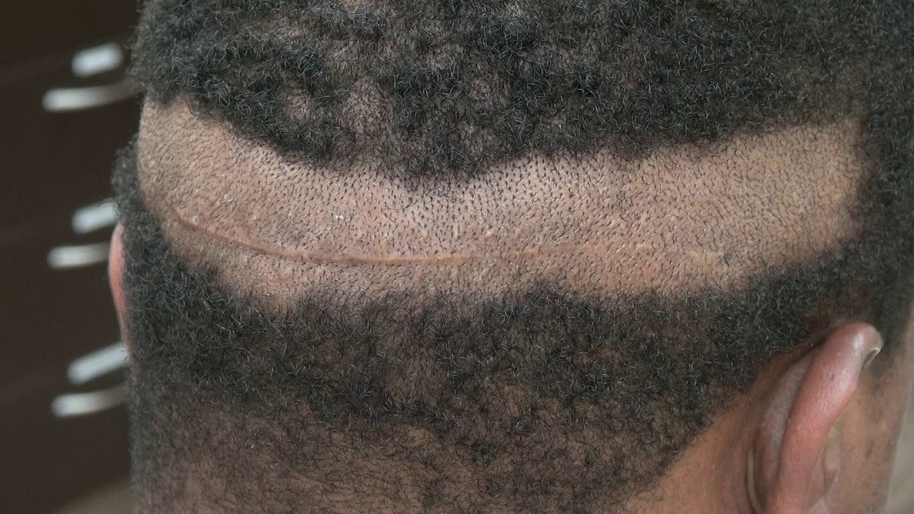 FUT Scar Demonstration by Dr. Diep FUT Hair Transplant Donor Linear ...