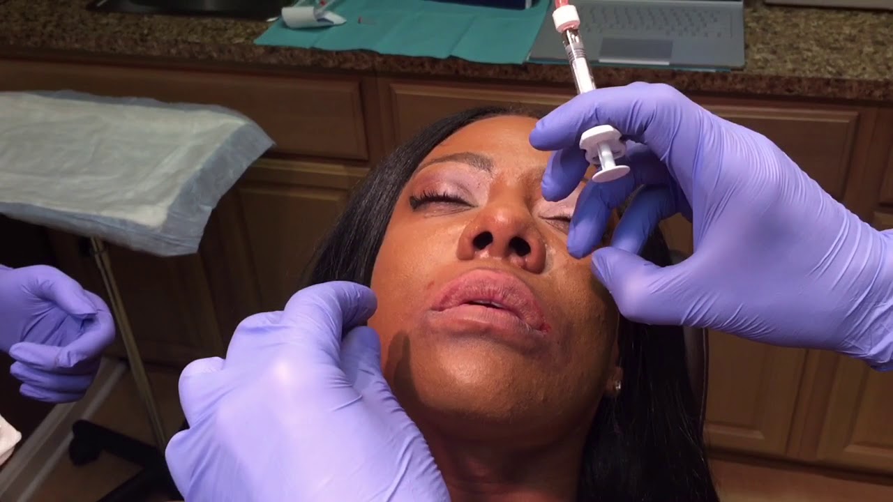 Micro-droplet Natural Top Lip Injection - YouTube