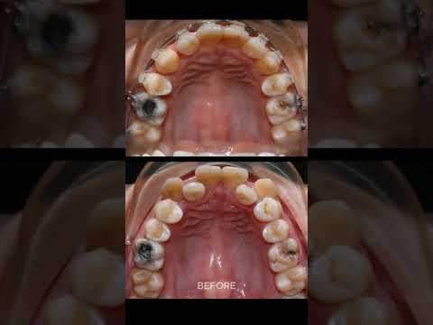 How Braces Move Their Teeth