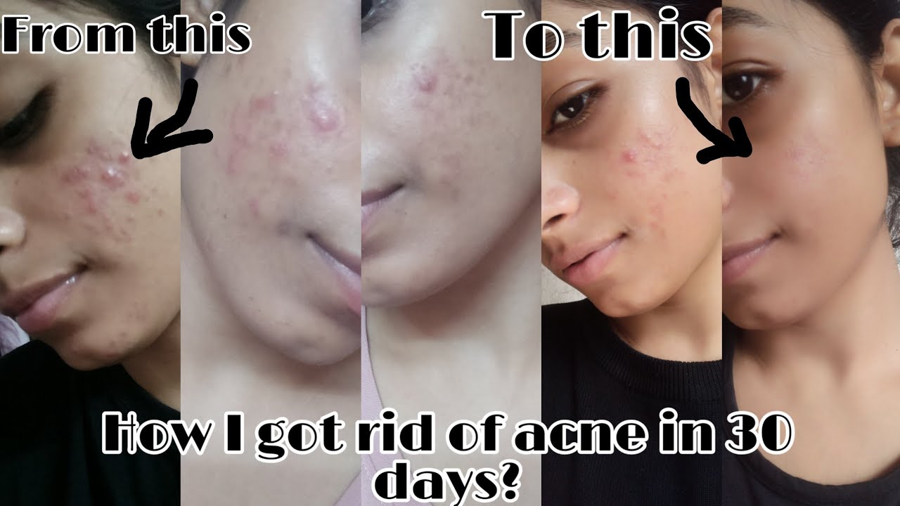 How I Got Rid Of My Stubborn Acne In 30 Days My Acne Journey Acne