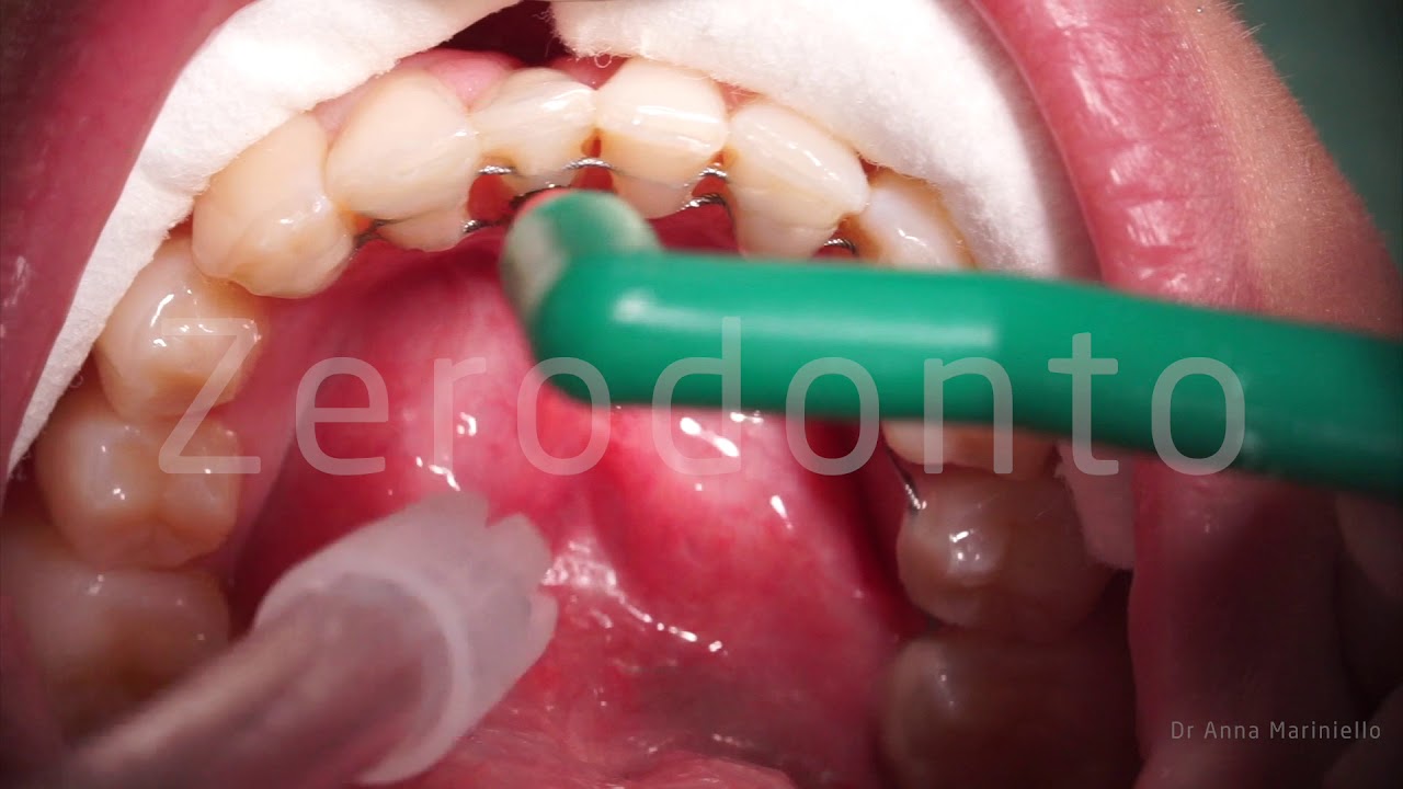 Torque management accomplished with a bracketless fixed orthodontic ...