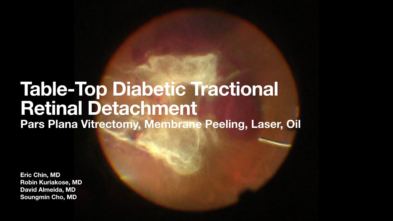 Table-Top Diabetic Tractional Retinal Detachment - YouTube