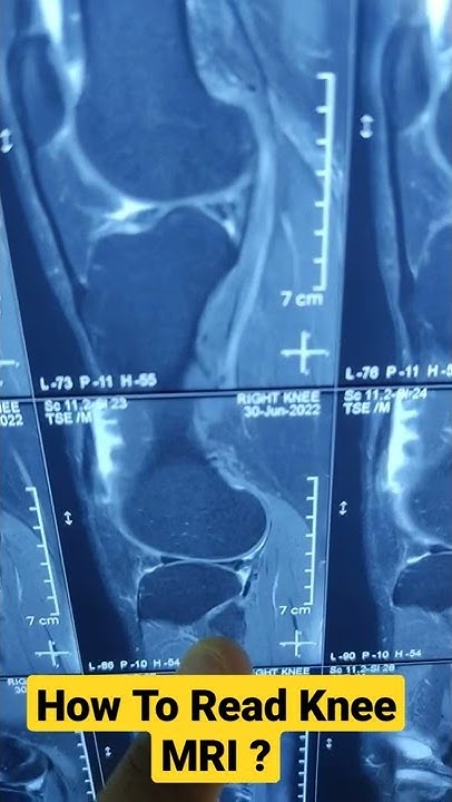How To Read Knee MRI ?Dr Sai Chandra - YouTube