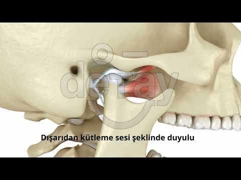 Eklem tedavisi / Çene kütlemesi nedir? 1