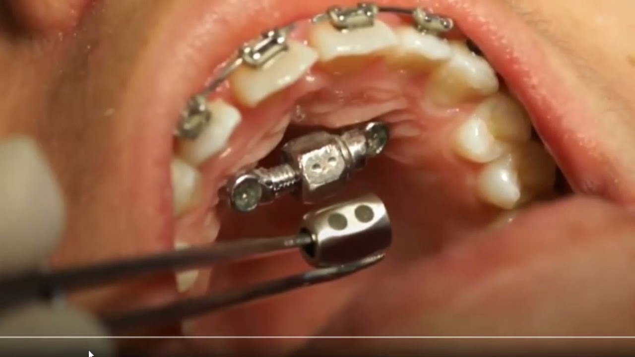 tiger screw - YouTube